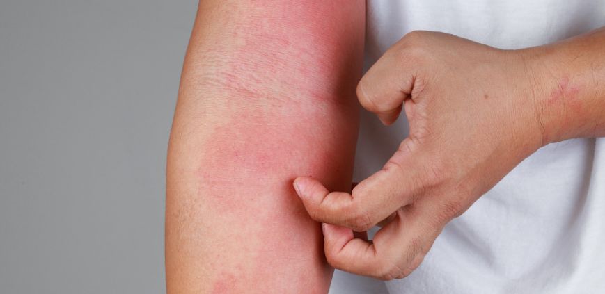 Scabies vs. Eczema: Know The Difference to Help Treat Your Skin Scabies vs. Eczema: Know The Difference to Help Treat Your Skin
